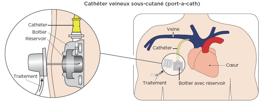 Portacath: What Is It, Why Is It Used, And More, 54% OFF